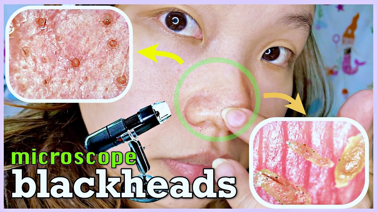 Blackheads Under Microscope